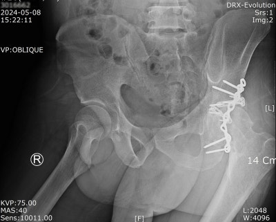 PELVIS AP, OBL,INLET,OUTLET,HIP JOINT 골반일반 촬영법 소개 : 네이버 블로그