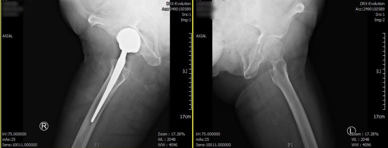PELVIS AP, OBL,INLET,OUTLET,HIP JOINT 골반일반 촬영법 소개 : 네이버 블로그