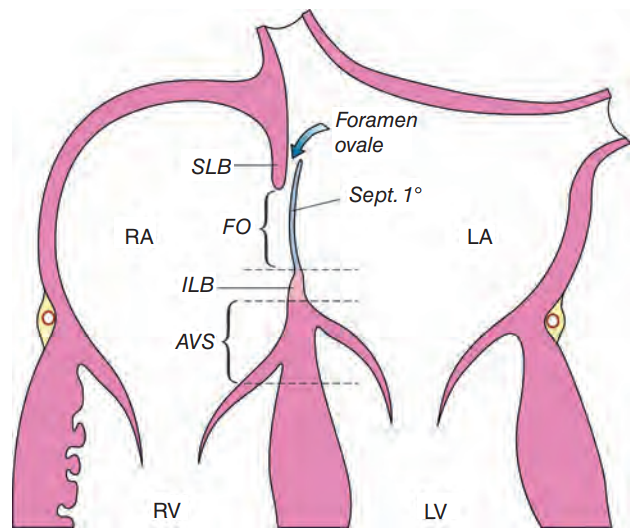 난원공 개존증 (Patent foramen ovale, PFO)과 심방 중격 결손(Atrial septal defect, ASD ...