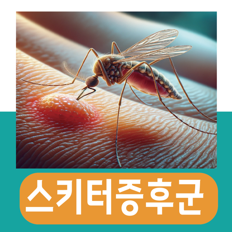 스키터증후군 모기 알러지 성인 아기 병원 치료 및 연고 사용 방법 네이버 블로그