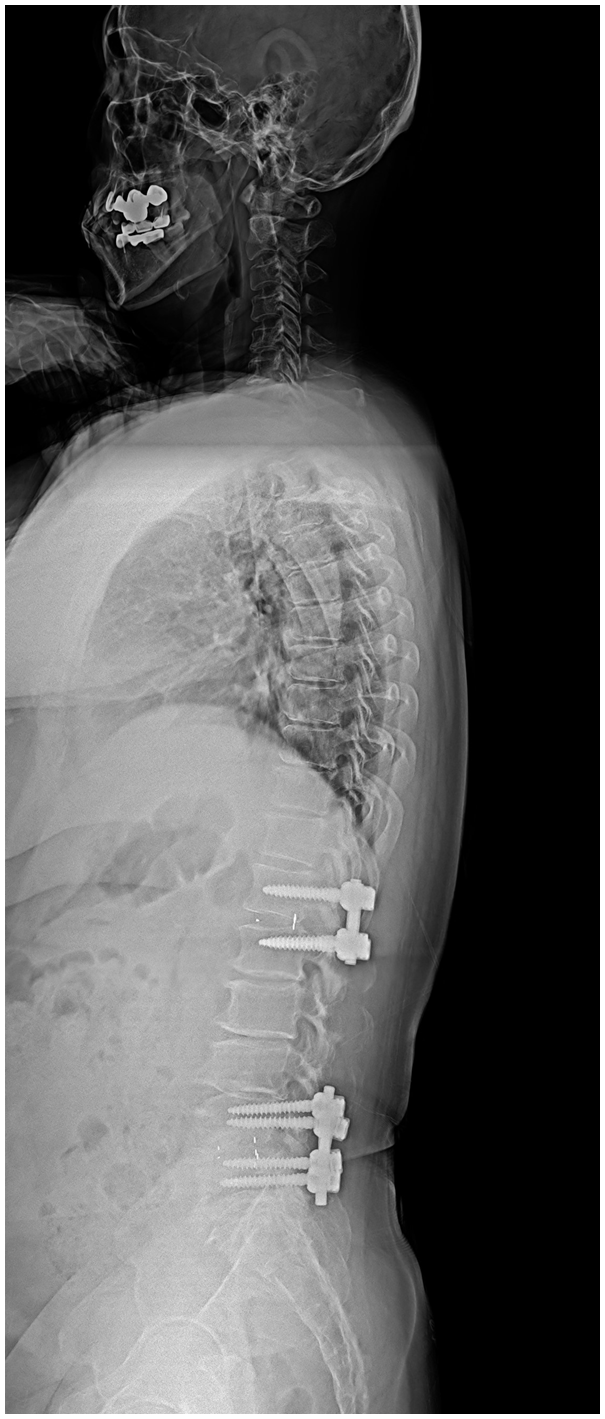 WHOLE SPINE AP,PA, LAT 촬영방법 소개(LONG BONE ) : 네이버 블로그