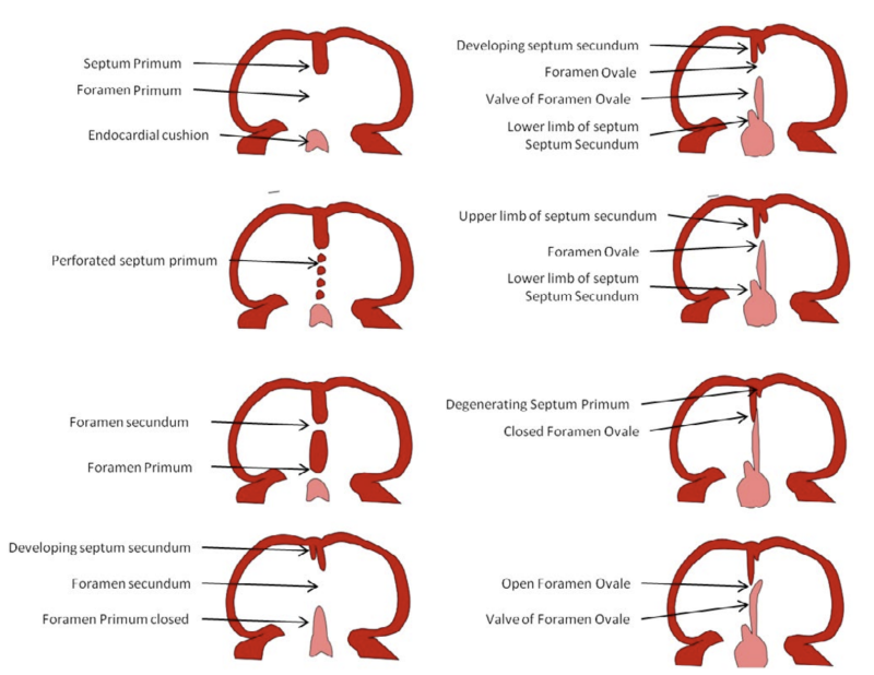 난원공 개존증 (Patent foramen ovale, PFO)과 심방 중격 결손(Atrial septal defect, ASD ...
