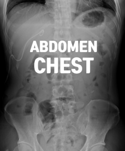 Chest PA,Abdomen Erect,KUB 가슴,복부 표준 촬영방법 소개 : 네이버 블로그