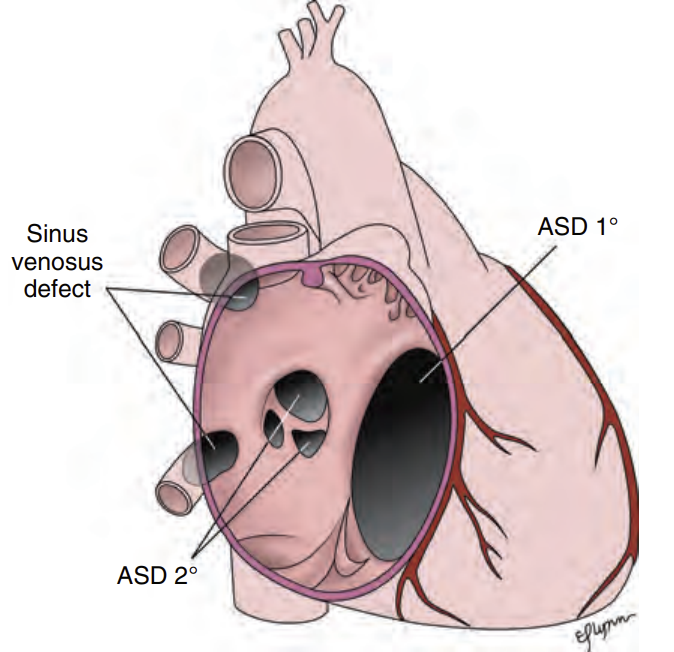 난원공 개존증 (Patent foramen ovale, PFO)과 심방 중격 결손(Atrial septal defect, ASD ...