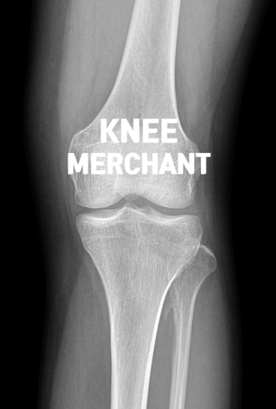 Knee AP,PA,ROSENBERG(Both Lat, Merchant)촬영법 무릎관절 X-RAY검사법 소개 : 네이버 블로그