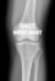 Knee AP,PA,ROSENBERG(Both Lat, Merchant)촬영법 무릎관절 X-RAY검사법 소개 : 네이버 블로그