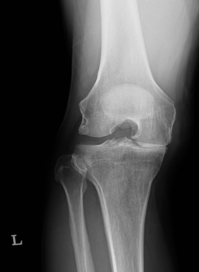 Knee AP,PA,ROSENBERG(Both Lat, Merchant)촬영법 무릎관절 X-RAY검사법 소개 : 네이버 블로그