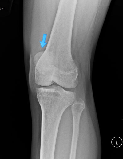 Knee AP,PA,ROSENBERG(Both Lat, Merchant)촬영법 무릎관절 X-RAY검사법 소개 : 네이버 블로그