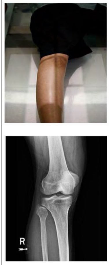Knee AP,PA,ROSENBERG(Both Lat, Merchant)촬영법 무릎관절 X-RAY검사법 소개 : 네이버 블로그