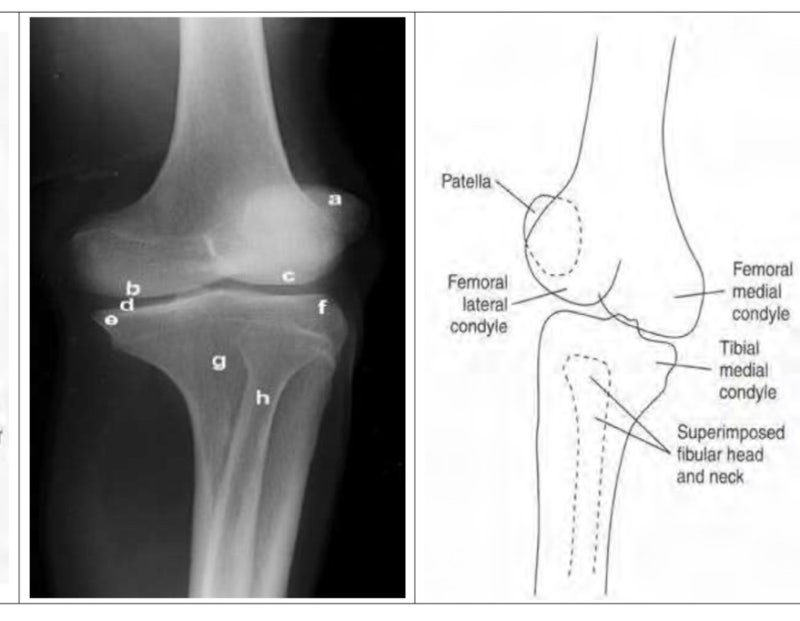Knee AP,PA,ROSENBERG(Both Lat, Merchant)촬영법 무릎관절 X-RAY검사법 소개 : 네이버 블로그