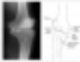 Knee AP,PA,ROSENBERG(Both Lat, Merchant)촬영법 무릎관절 X-RAY검사법 소개 : 네이버 블로그