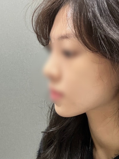 청담동 피부과 튠페이스 블루팁 내돈내산 후기 효과 볼패임없는 고주파리프팅 추천 네이버 블로그