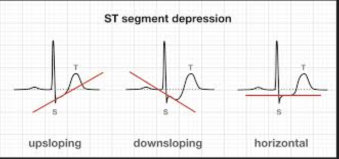EKG ST depression (ST 하강) : 임상적 의미와 치료에 대해~ : 네이버 블로그