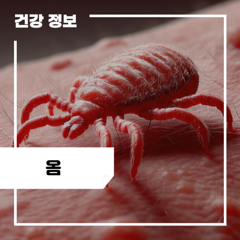 옴 초기증상 및 치료 연고 완치 유무 예방 방법 옴진드기 네이버 블로그