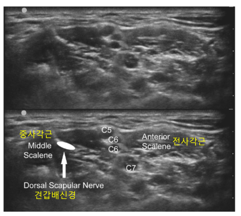 견갑골 내측 사이 통증【견갑배 신경 포착 Dorsal Scapular Nerve Entrapment】 네이버 블로그