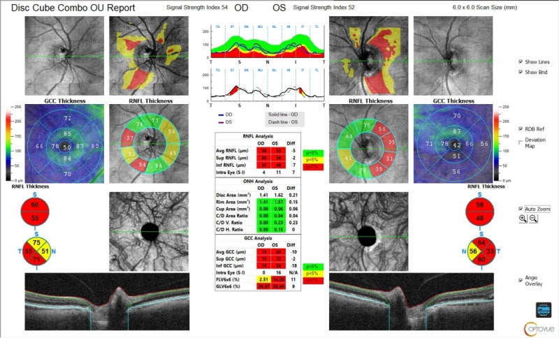 [의료기기 #1] 빛간섭단층촬영, 안구광학단층촬영, OCT, Optical coherence tomography : 네이버 블로그