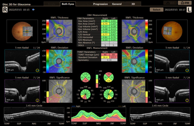 [의료기기 #1] 빛간섭단층촬영, 안구광학단층촬영, OCT, Optical coherence tomography : 네이버 블로그