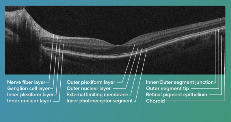 [의료기기 #1] 빛간섭단층촬영, 안구광학단층촬영, OCT, Optical coherence tomography : 네이버 블로그