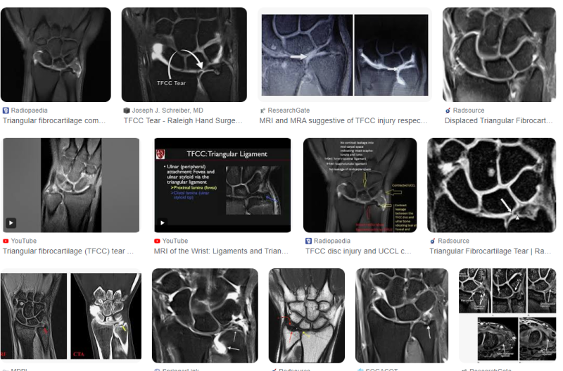 TFCC 손상 검사 정확도는 얼마나? 단계별 치료방법은 : 네이버 블로그