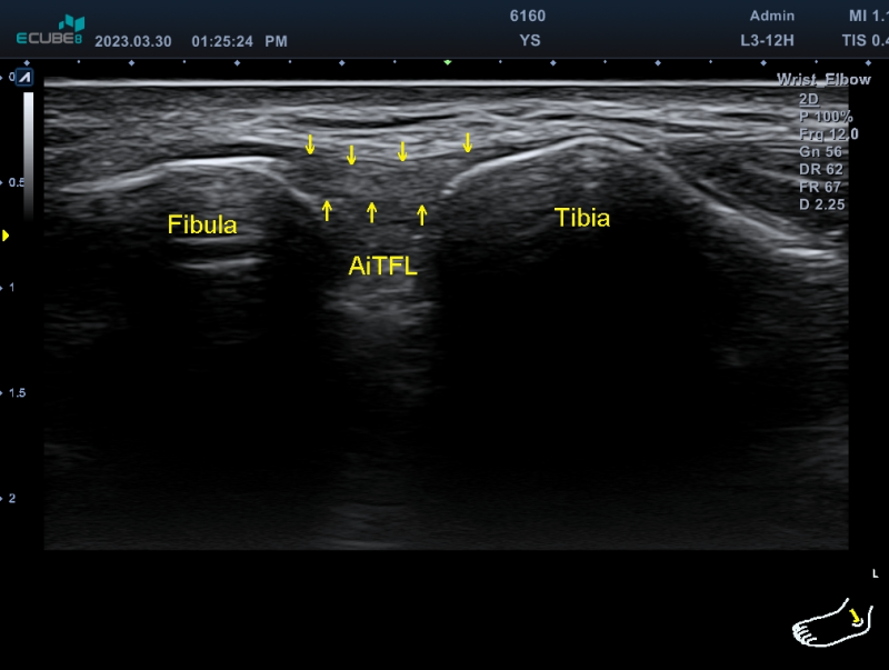 발목 통증 / 전거비인대 (ATFL) 종비인대 (CFL) 전하경비인대(AiTFL) 파열 치료 포인트 : 네이버 블로그