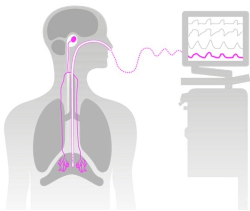 신생아 산소요법 정리(NP, HF, NCPAP, NIPPV, NAVA, HFV) : 네이버 블로그