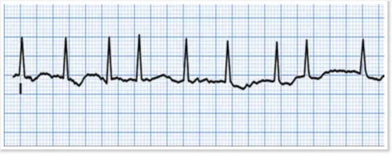 A.fib RVR의 원인, 치료, 합병증에 대해서 알아봐요~ : 네이버 블로그