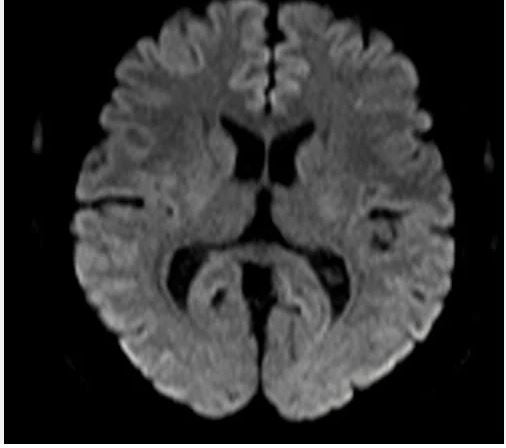 Diffusion MRI의 정의와 목적에 대해서 알아봐요~ : 네이버 블로그