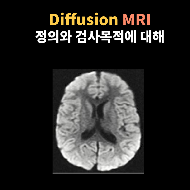 Diffusion MRI의 정의와 목적에 대해서 알아봐요~ : 네이버 블로그