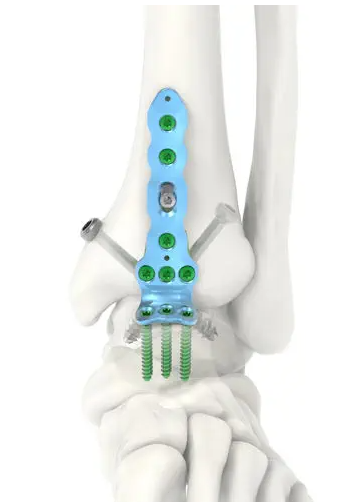 Ankle-Arthrodesis (AA) Tibio-talar fusion 발목관절 유합술 : 네이버 블로그