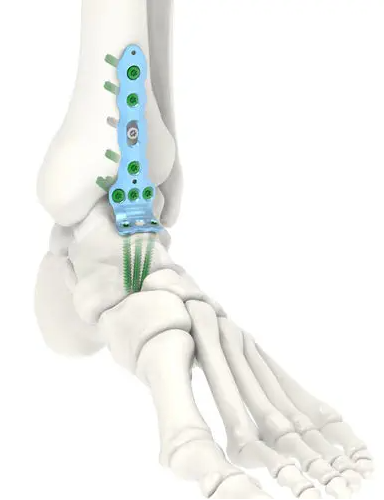 Ankle-Arthrodesis (AA) Tibio-talar fusion 발목관절 유합술 : 네이버 블로그