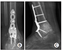 Ankle-Arthrodesis (AA) Tibio-talar fusion 발목관절 유합술 : 네이버 블로그
