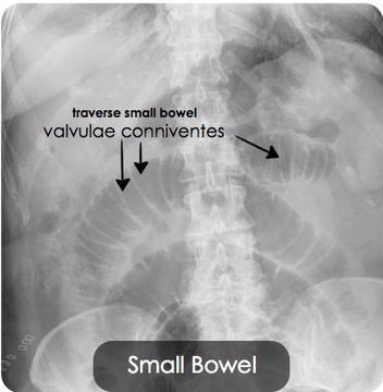 의학용어 ileus (장 폐색) Intestinal obstruction (장 폐쇄) 원인, 치료 등을 알아보자! : 네이버 블로그