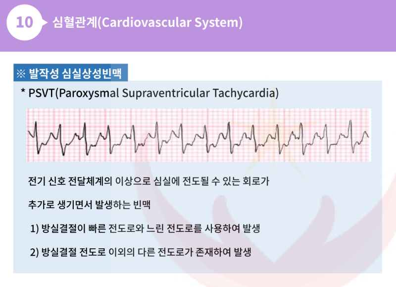 부정맥 arrhythmia 간호 총정리ㅣ의학용어 VT(V-tach),PSVT : 네이버 블로그