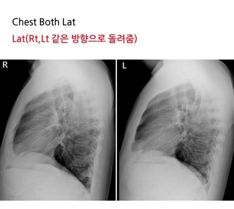 Chest PA,Abdomen Erect,KUB 가슴,복부 표준 촬영방법 소개 : 네이버 블로그