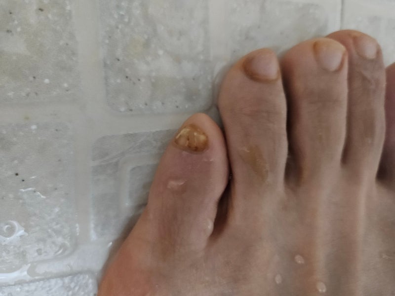 발톱 무좀에 좋은 셀라큐어 문제성 발톱솔루션 리얼 후기 네이버 블로그