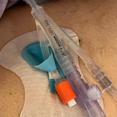 foley 2way 3way ballooning leakage 대처 방법 : 네이버 블로그