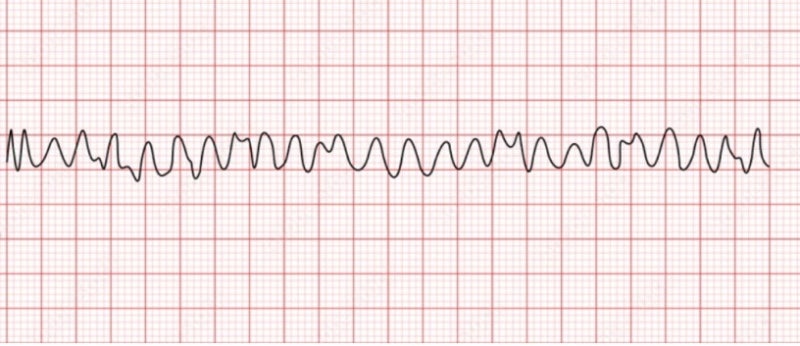 Cardioversion / Defibrillation 차이점 : shock, 제세동기 적응증, CPR rhythm : 네이버 블로그