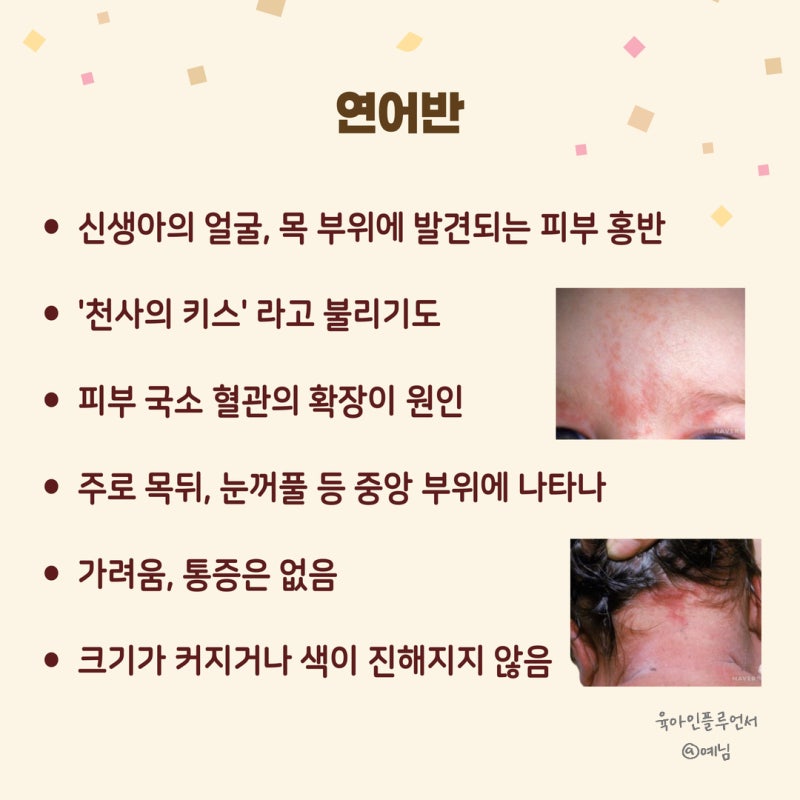 신생아 연어반 목뒤 눈 이마 두피 얼굴 없어지는 시기 치료방법 네이버 블로그