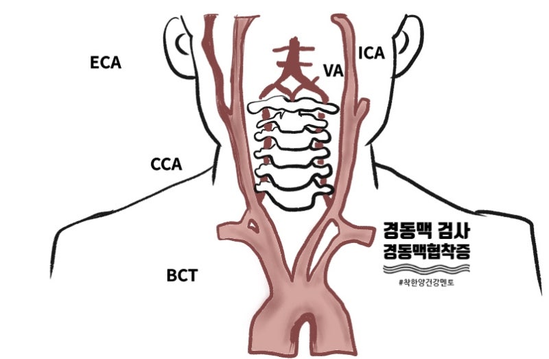 경동맥협착증 과 경동맥초음파 표준검사지침 네이버 블로그