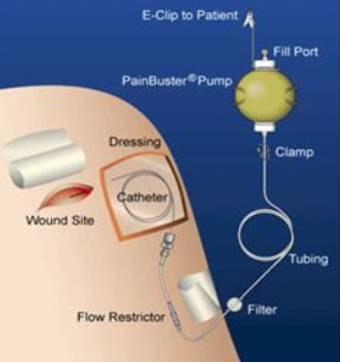 페인부스터/ 페인버스터(pain buster)와 무통 주사(IV PCA, 자가 진통 조절장치) 차이는 무엇일까? : 네이버 블로그