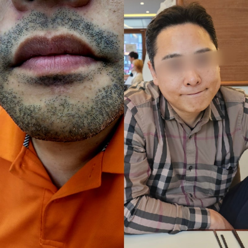 남자 수염제모 수염자국 레이저 제모기 다리 겨드랑이 브라질리언 제모 가격 기간 횟수 추천 아포지엘리트 플러스 후기 네이버 블로그