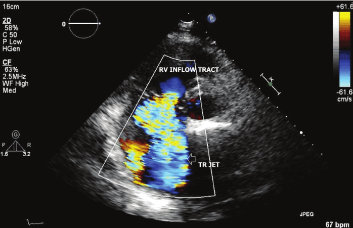 심장초음파 view 별 measure 측정 포인트, 정상 범위 : 네이버 블로그