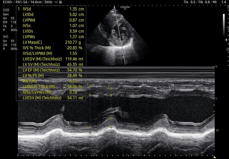 심장초음파 view 별 measure 측정 포인트, 정상 범위 : 네이버 블로그