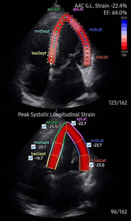 심장초음파 view 별 measure 측정 포인트, 정상 범위 : 네이버 블로그