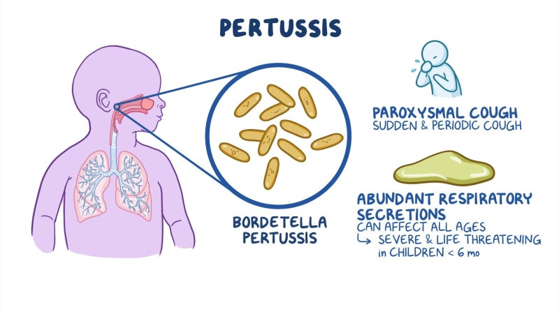 백일해(Pertussis) 원인, 증상, 검사와 예방접종 : 네이버 블로그