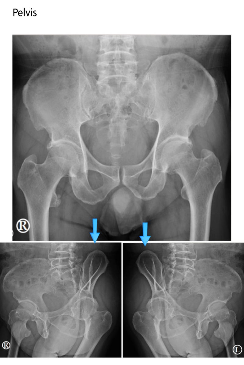 PELVIS AP, OBL,INLET,OUTLET,HIP JOINT 골반일반 촬영법 소개 : 네이버 블로그