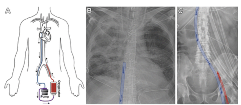 ECMO간호 VV ECMO와 VA ECMO 정복하기. 적용중 합병증과 Flow조절 : 네이버 블로그