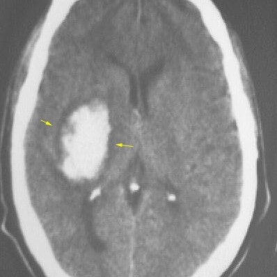[응급실 간호] cerebral hemorrhage - 뇌출혈 (EDH,SDH,SAH,ICH) 종류 및 증상과 간호 : 네이버 블로그