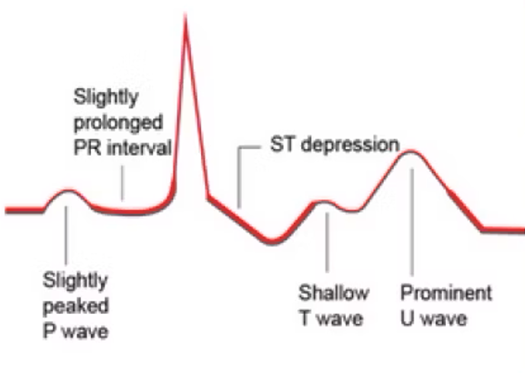 [NCLEX] Cardiovascular 심부전 & 저칼륨혈증/고칼륨혈증 정리 : 네이버 블로그