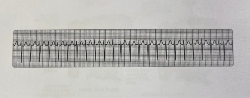 PSVT : paroxysmal supraventricular tachycardia, EKG 리듬, 발작성심실상성빈맥 치료 방법 ...